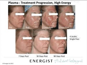 Neogen and Plasma Treatment | Lasting Impression Medical Spa