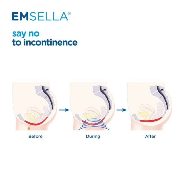 Fair Lawn Emsella Incontinence Treatment - Bergen County Medical Spa